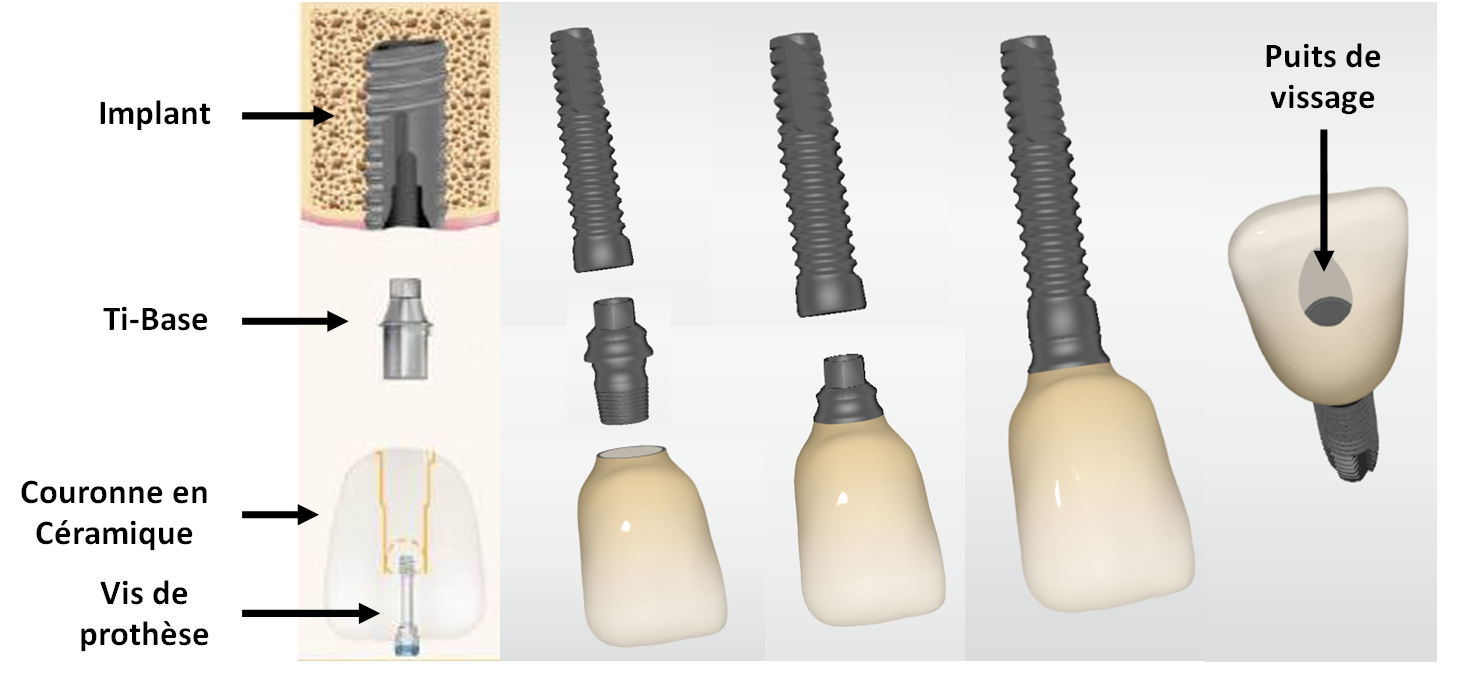 Recommandations suite à la pose d'une prothèse supra-implantaire ...